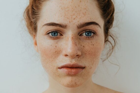 Can You Really Get Rid of Freckles? - Dermatology Services Brookhaven ...