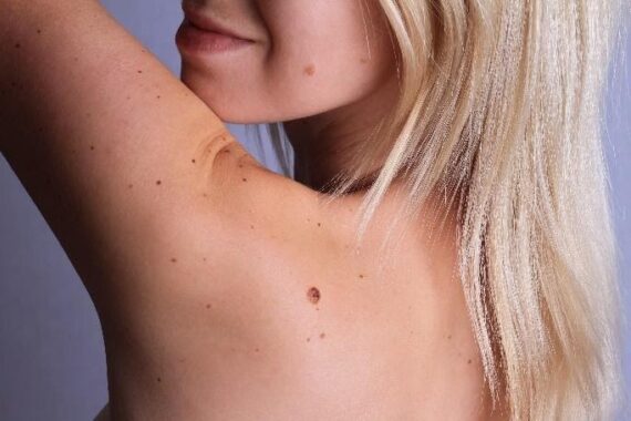 How to Know If Your Mole Is Suspicious - Dermatology Services ...
